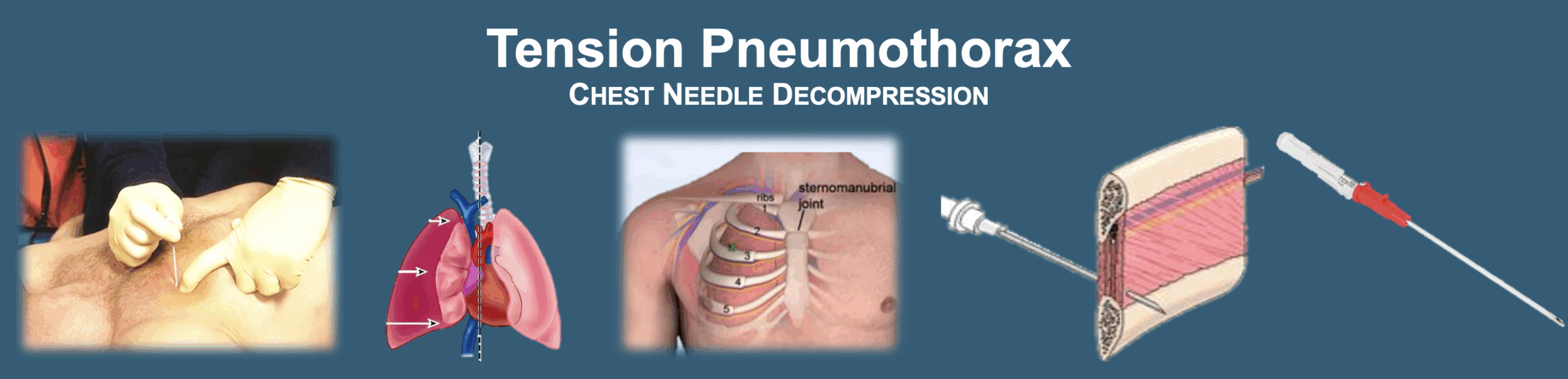 Tension Pneumothorax - (Post DMT) - Trauma Training
