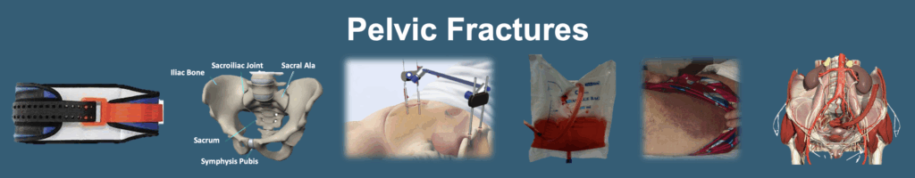 Pelvic Fractures - (DMT) - Trauma Training