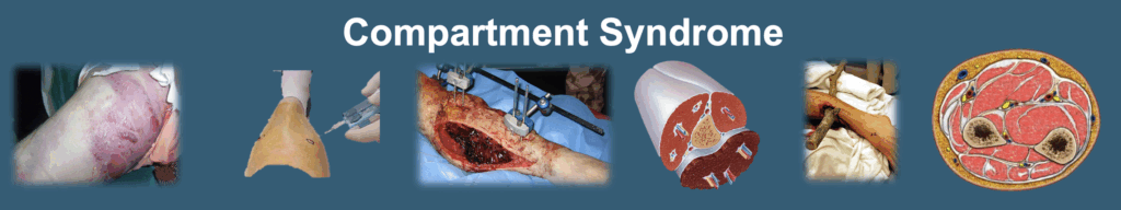 Compartment Syndrome - (DMT) - Trauma Training