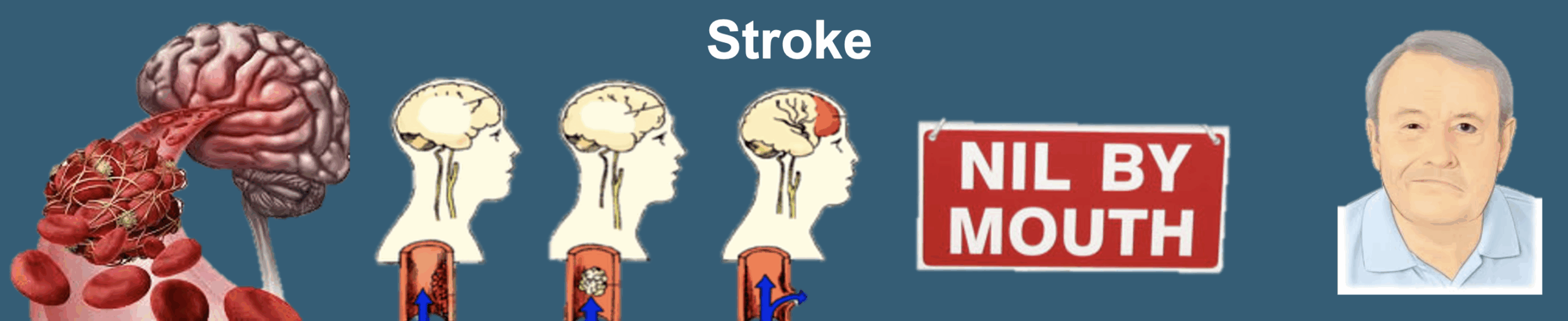Stroke (CVA) - (First Aid) - Trauma Training